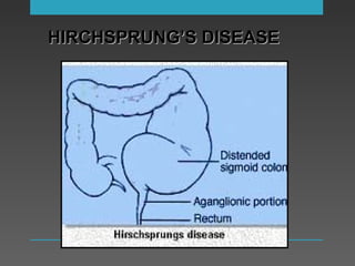 HIRCHSPRUNG’S DISEASE | PPT