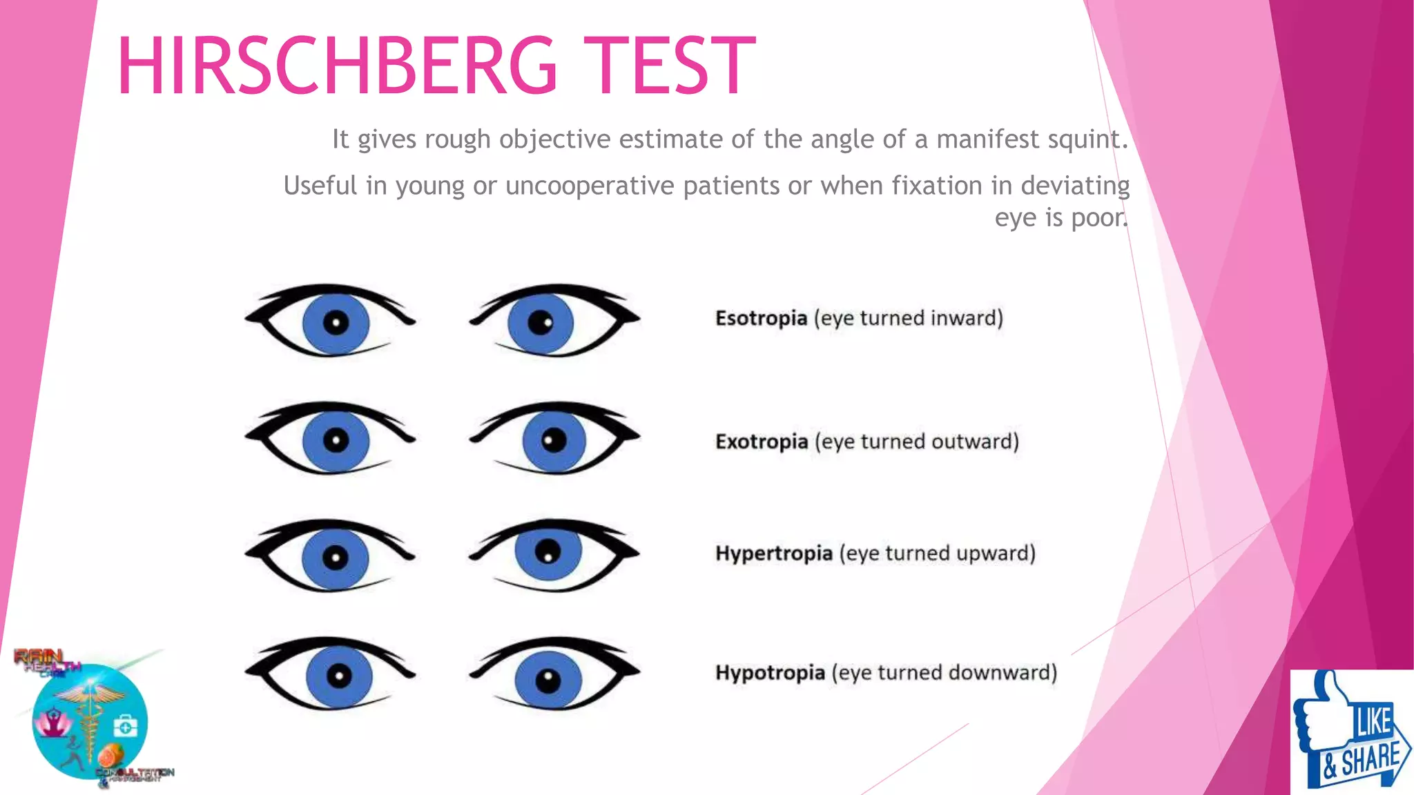 Hirschberg test | PPTX