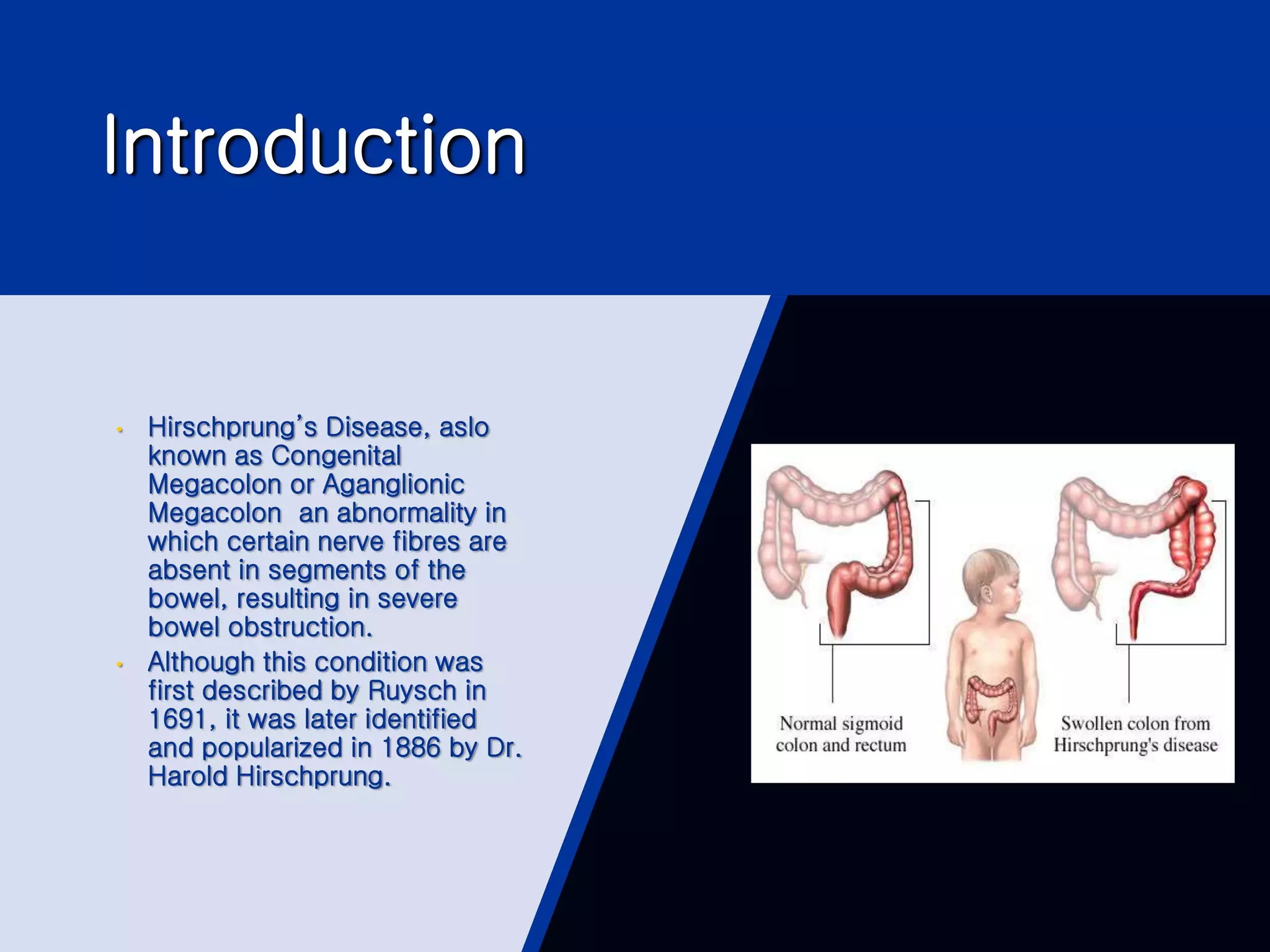 Hirschprung"s disease | PPTX