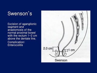 Hirschprung"s disease | PPTX