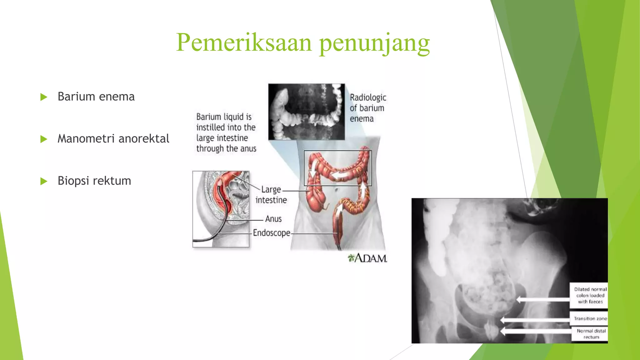 Hirschsprung-1.pptx