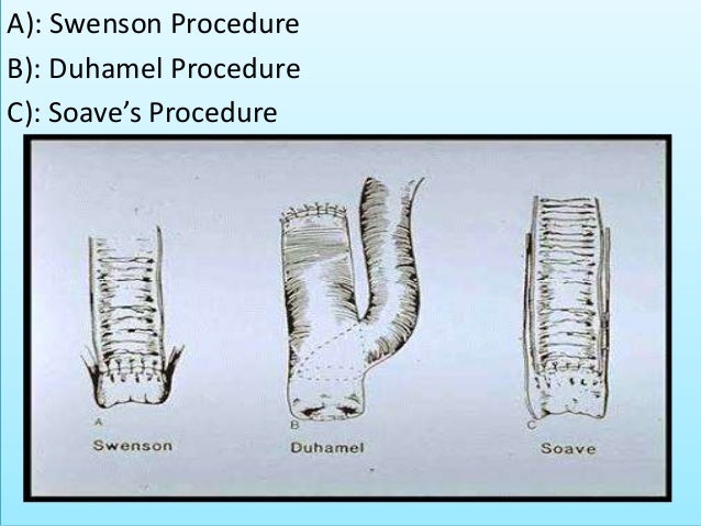 Hirschsprung disease