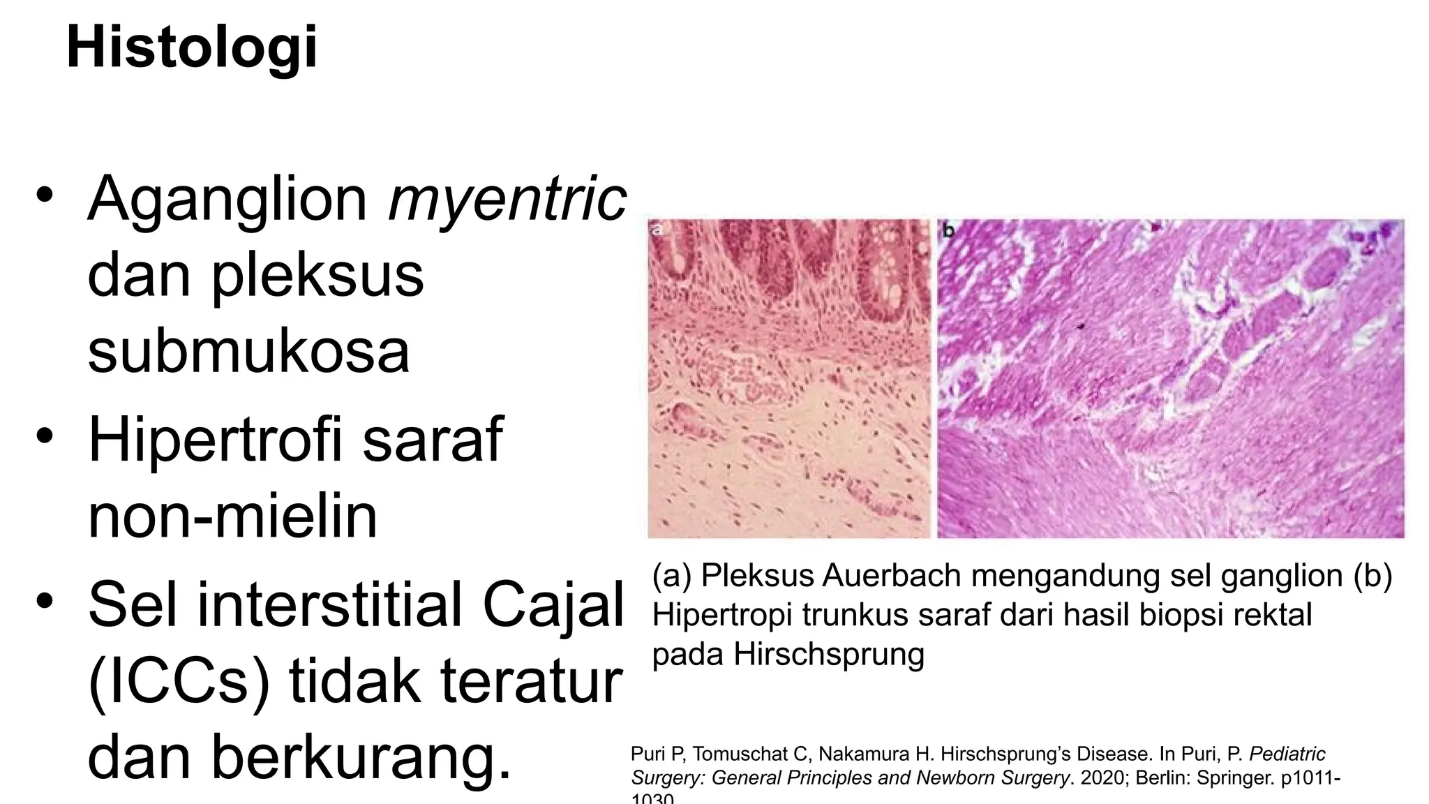 Hirschsprung tinjaun pustaka untuk belajar .pptx