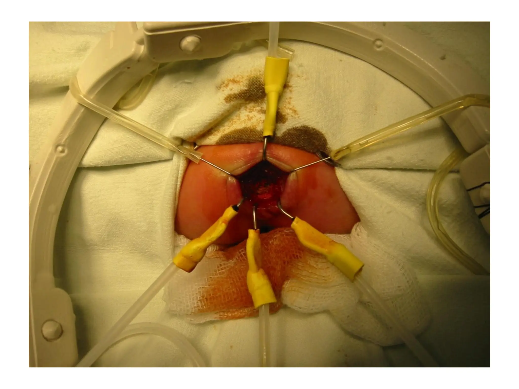 TIEP CAN BENH HIRSCHSPRUNG O TRE EM .pdf