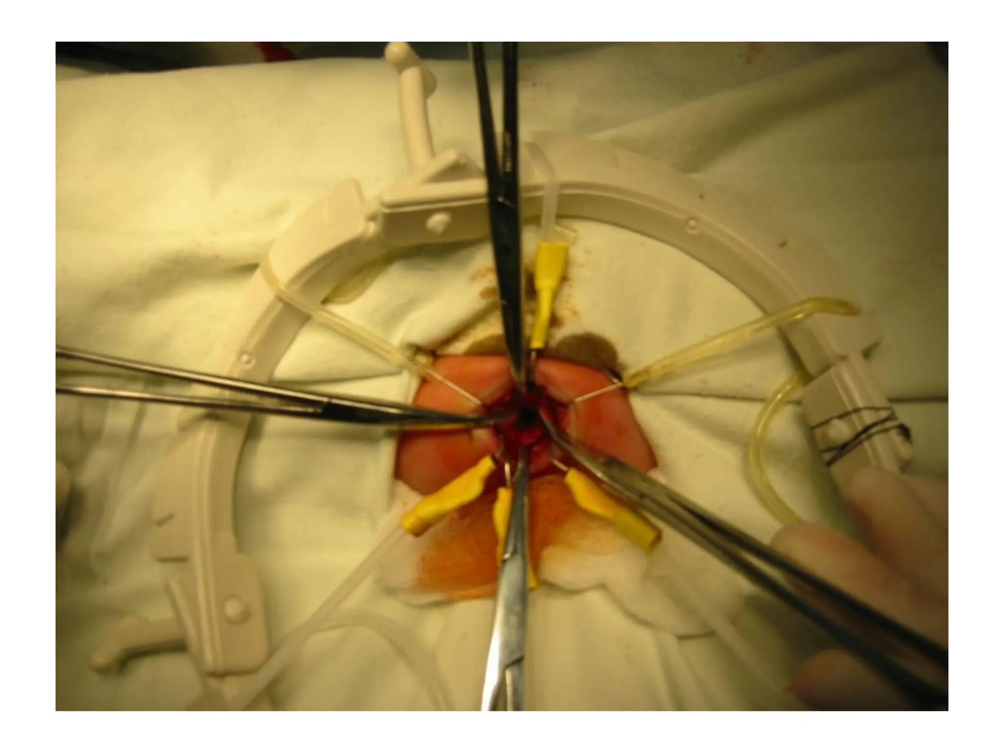 TIEP CAN BENH HIRSCHSPRUNG O TRE EM .pdf