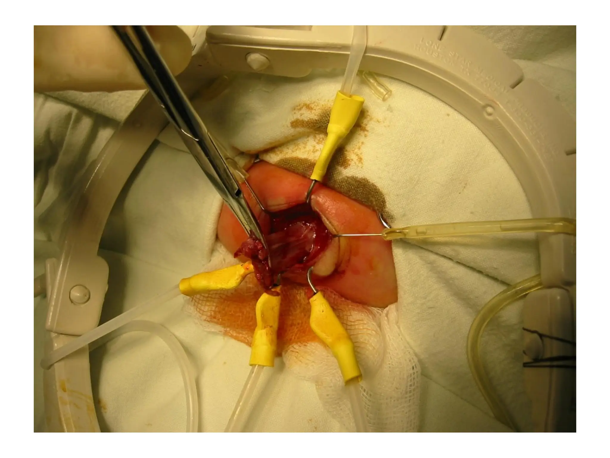 TIEP CAN BENH HIRSCHSPRUNG O TRE EM .pdf