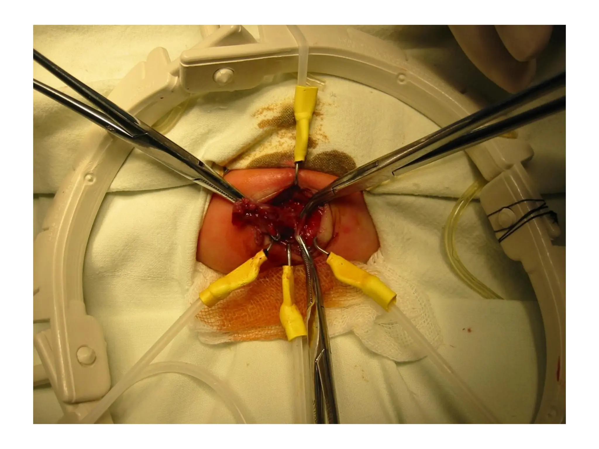 TIEP CAN BENH HIRSCHSPRUNG O TRE EM .pdf