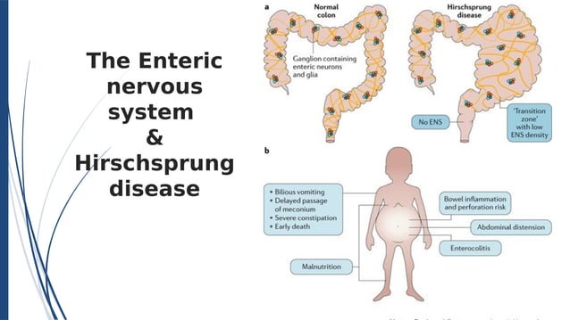 Hirschsprung Disease - Approach & Management