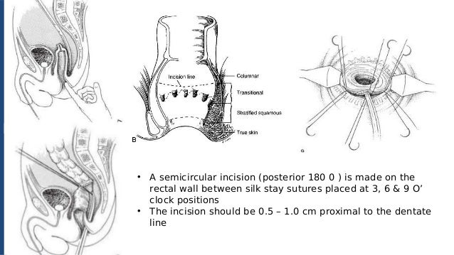 Hirschsprung Disease - Approach & Management