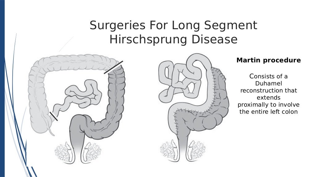 Hirschsprung Disease - Approach & Management