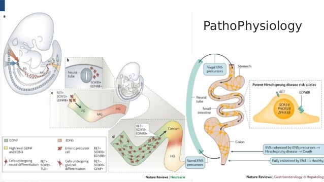 Hirschsprung Disease - Approach & Management