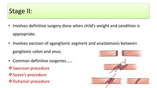 HIRSCHSPRUNG DISEASE | PPTX