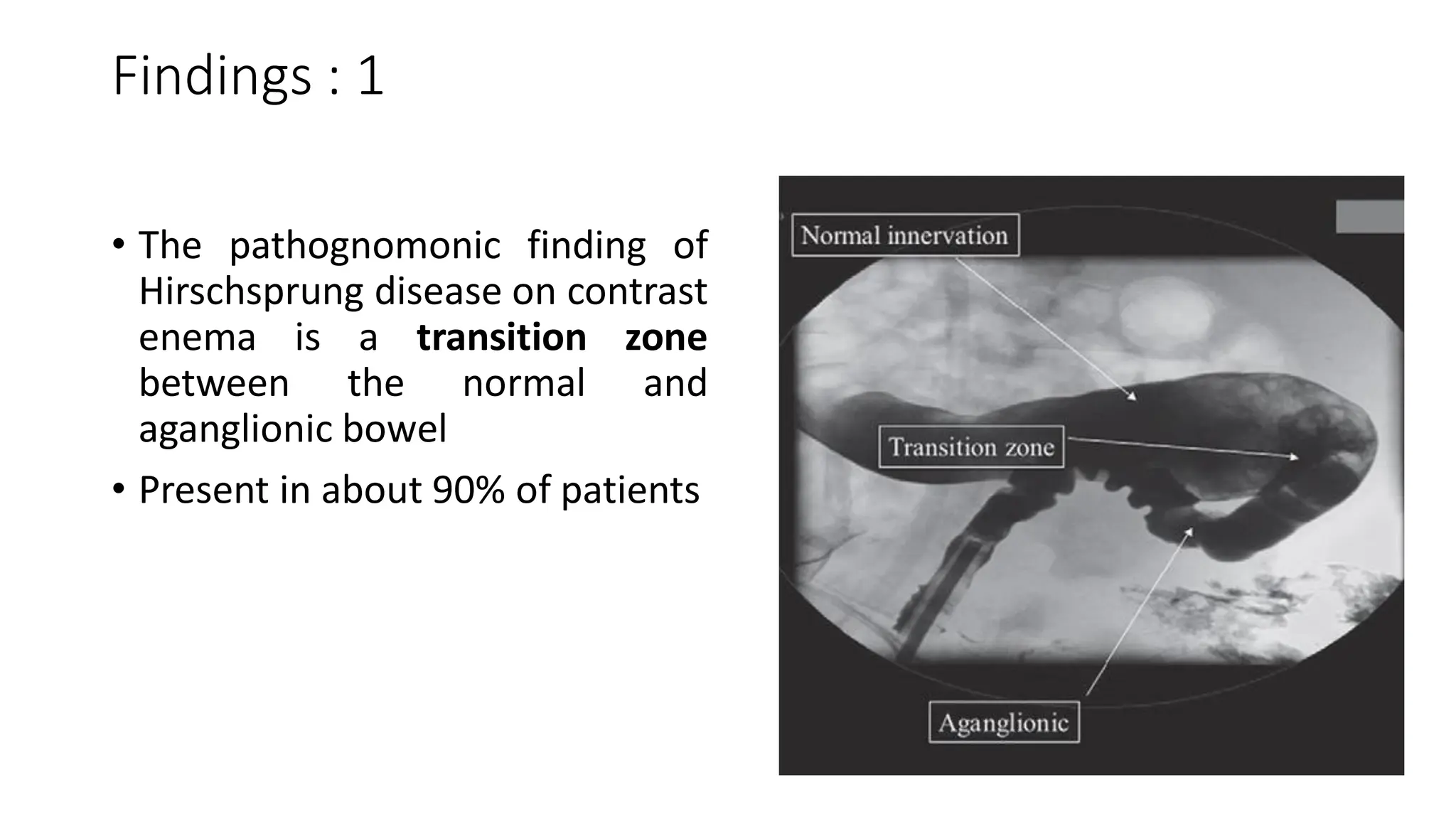 HIRSCHSPRUNG DISEASE.pdf AGANGLIONIC MEGACOLON, CONGENITAL MEGACOLON | PDF