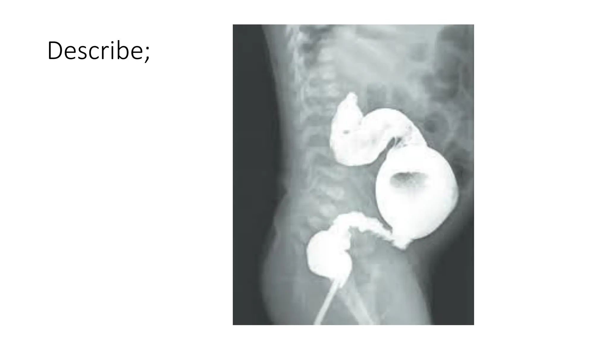 HIRSCHSPRUNG DISEASE.pdf AGANGLIONIC MEGACOLON, CONGENITAL MEGACOLON | PDF