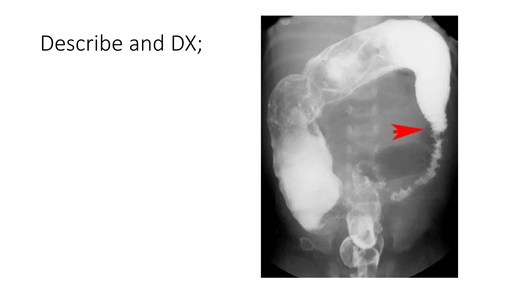 HIRSCHSPRUNG DISEASE.pdf AGANGLIONIC MEGACOLON, CONGENITAL MEGACOLON | PDF