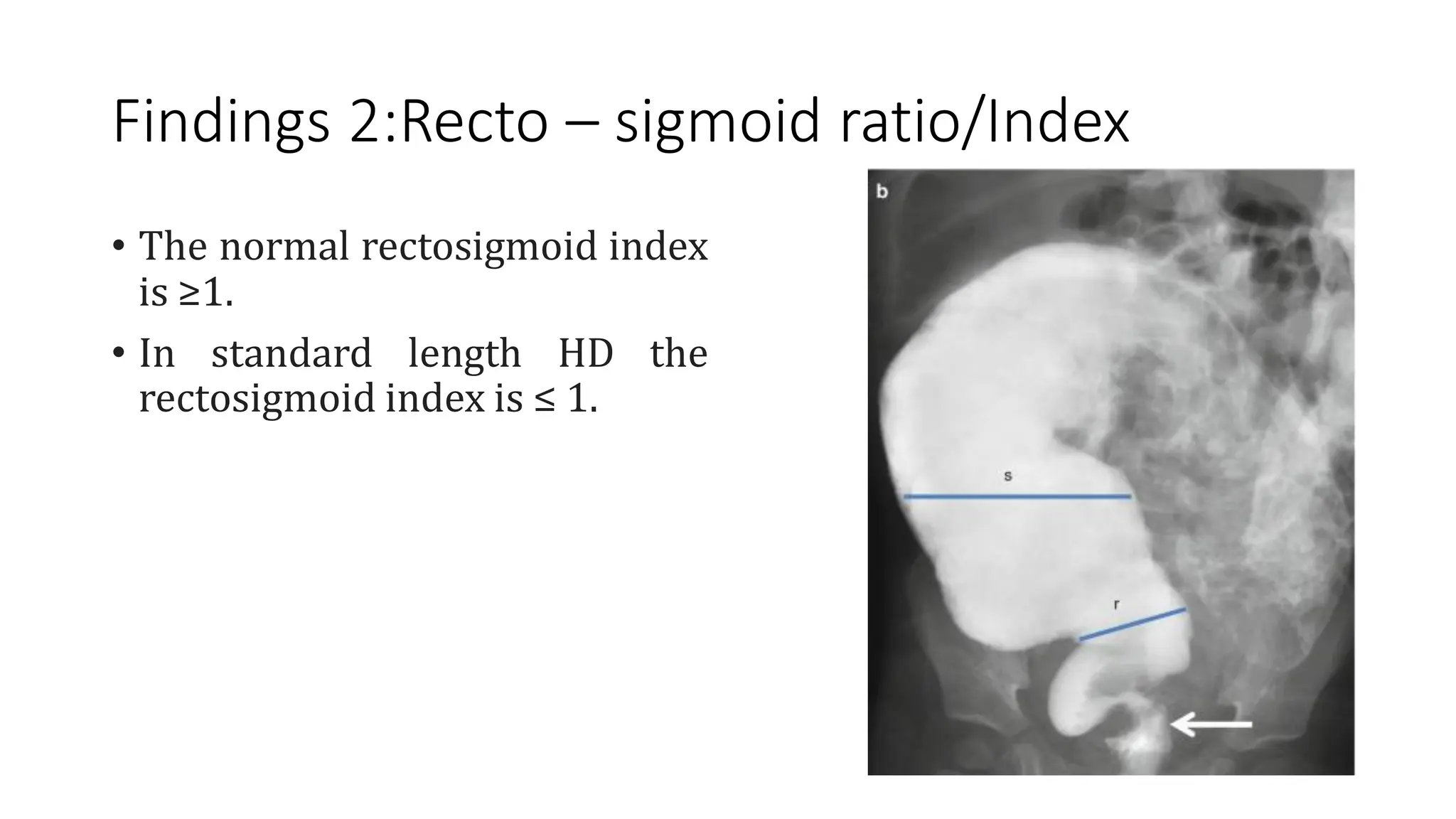 HIRSCHSPRUNG DISEASE.pdf AGANGLIONIC MEGACOLON, CONGENITAL MEGACOLON | PDF