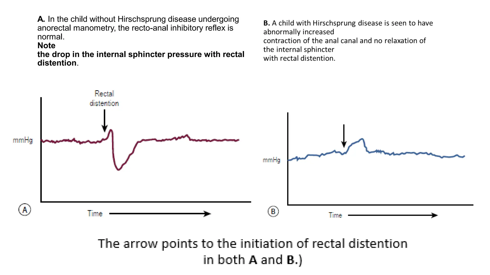HIRSCHSPRUNG DISEASE.pdf AGANGLIONIC MEGACOLON, CONGENITAL MEGACOLON | PDF