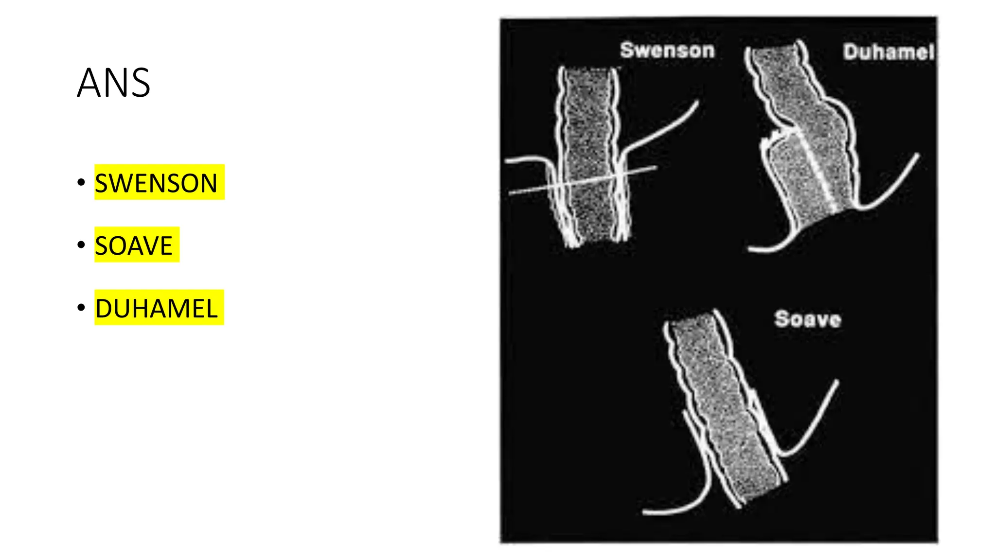 HIRSCHSPRUNG DISEASE.pdf AGANGLIONIC MEGACOLON, CONGENITAL MEGACOLON | PDF
