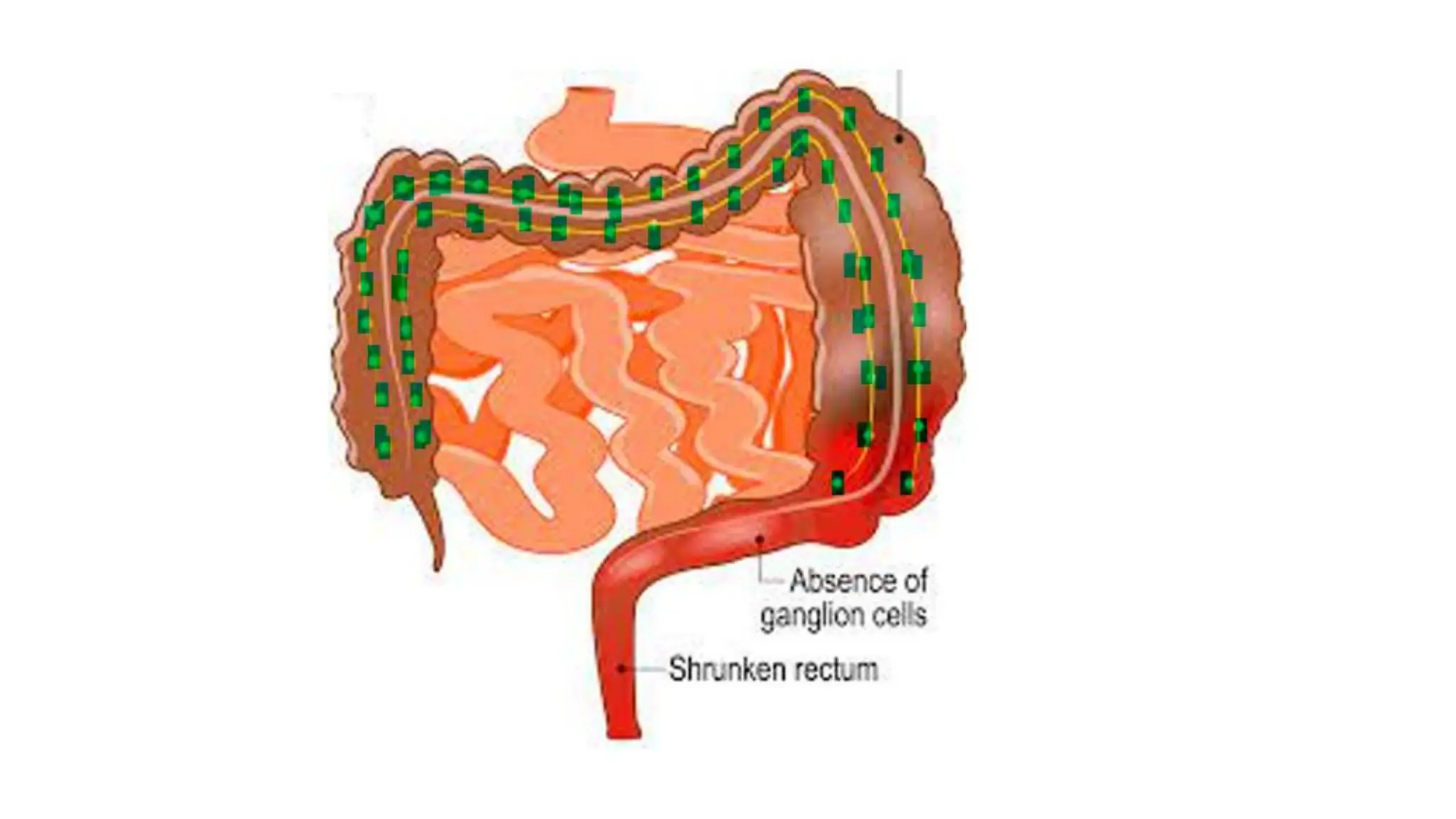 HIRSCHSPRUNG DISEASE.pdf AGANGLIONIC MEGACOLON, CONGENITAL MEGACOLON | PDF
