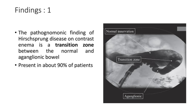 HIRSCHSPRUNG DISEASE.pdf AGANGLIONIC MEGACOLON, CONGENITAL MEGACOLON | PDF