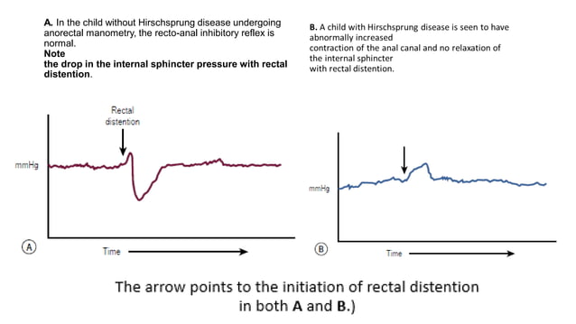 HIRSCHSPRUNG DISEASE.pdf AGANGLIONIC MEGACOLON, CONGENITAL MEGACOLON | PDF