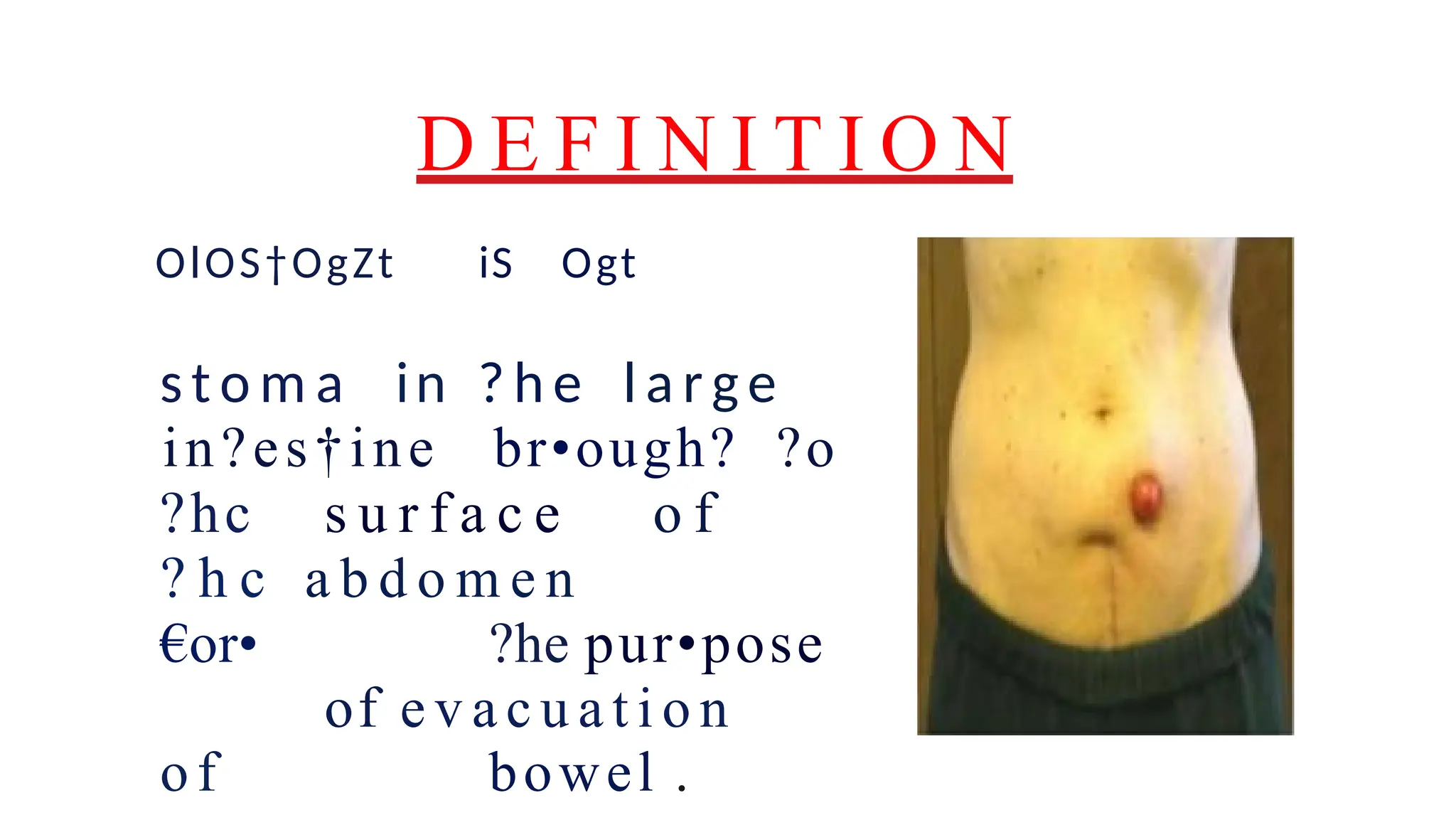 hirschsprung disease HD raghufor class.pptx