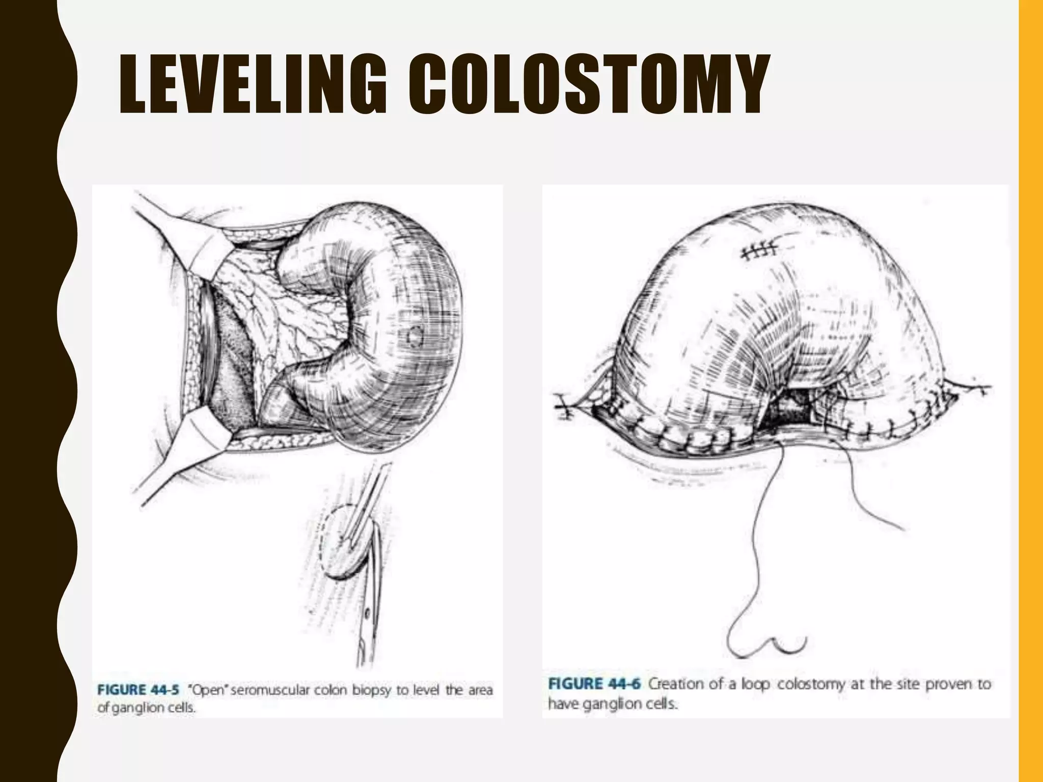 Hirschsprung Disease.pptx