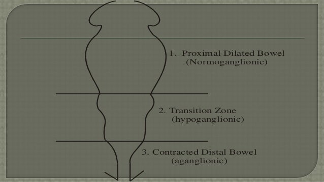 Hirschsprung’s disease
