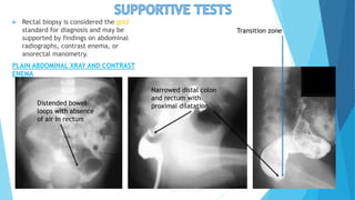Hirschsprungs disease | PPT