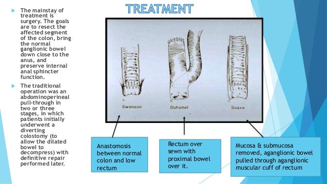 Hirschsprungs disease