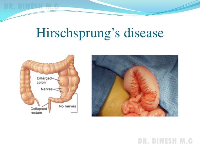 Hirschsprung's disease