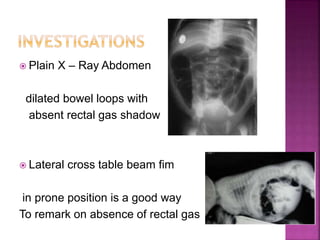 Hirschsprung’s disease.pptx | PPTX