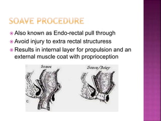 Hirschsprung’s disease.pptx | PPT