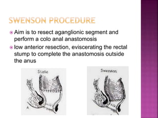 Hirschsprung’s disease.pptx | PPT