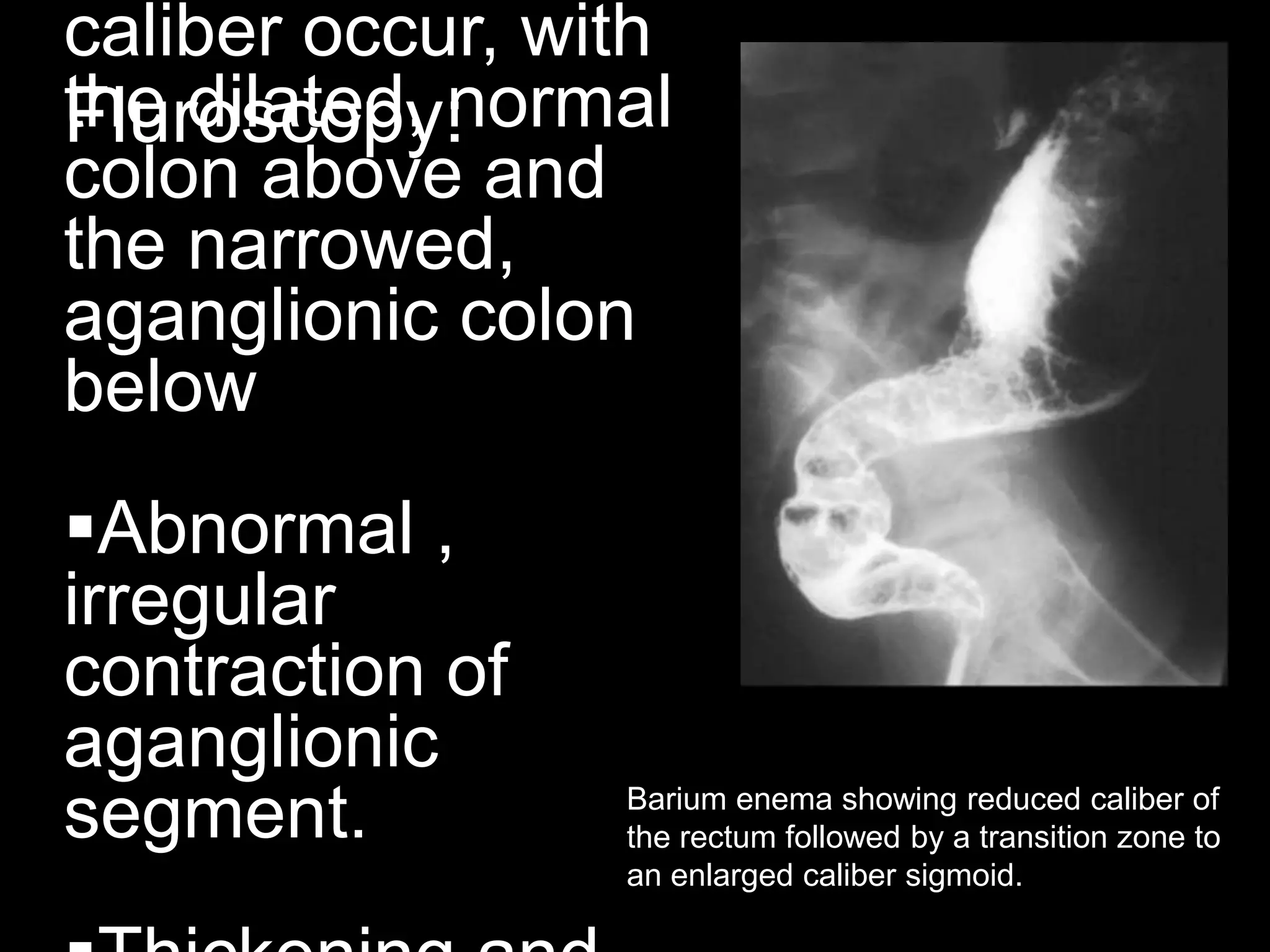 Hirschsprung's disease.pptx
