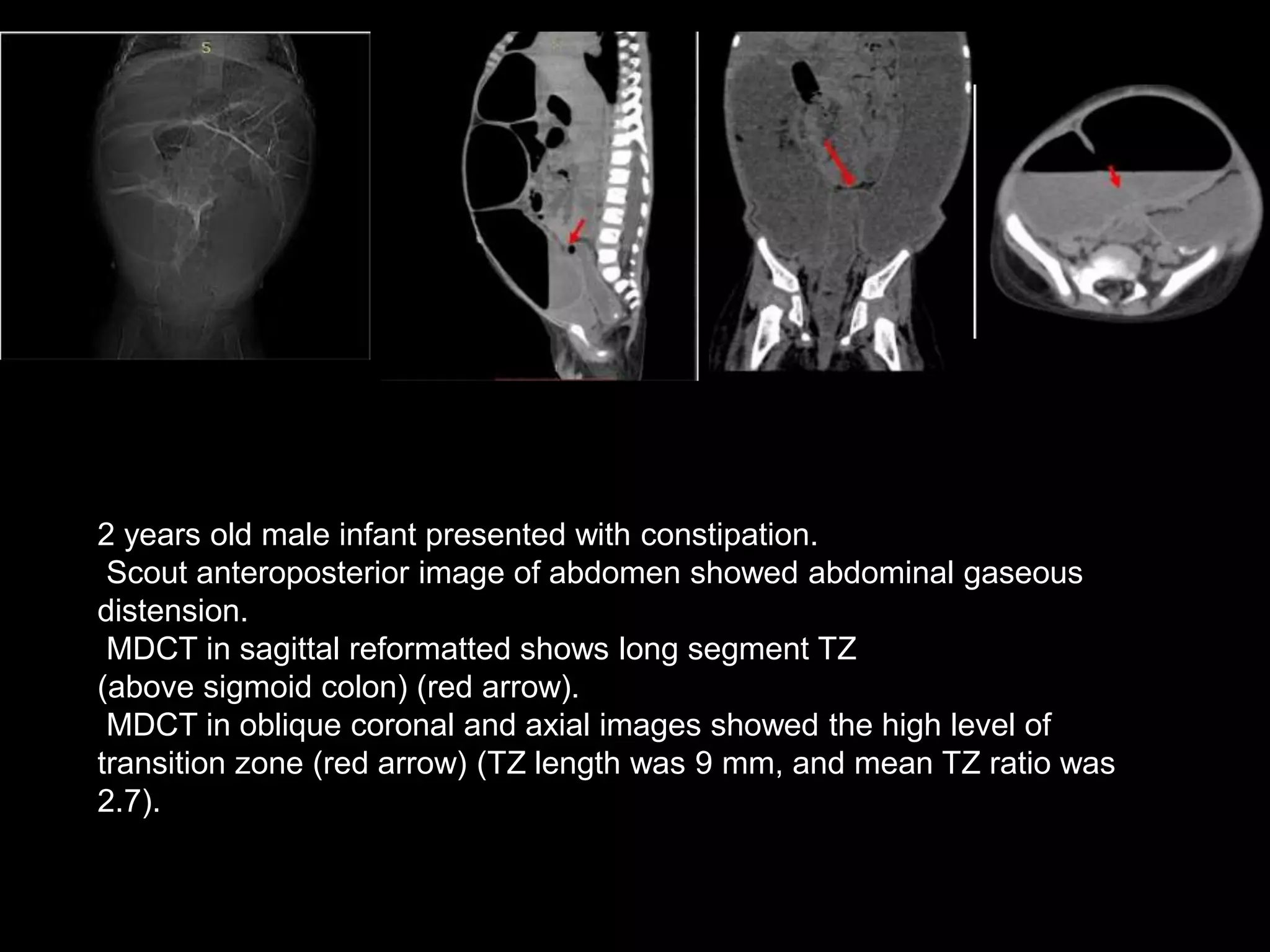Hirschsprung's disease.pptx