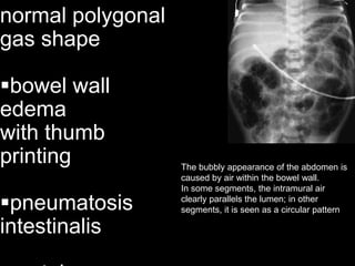 Hirschsprung's disease.pptx