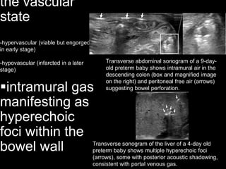 Hirschsprung's disease.pptx