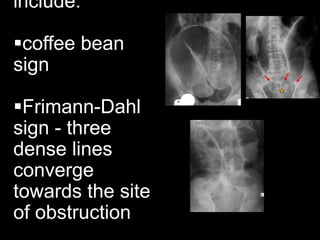 Hirschsprung's disease.pptx