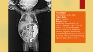 surgery - of Hirschsprung’s Disease.pptx