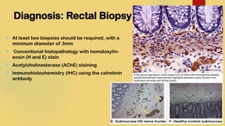 surgery - of Hirschsprung’s Disease.pptx