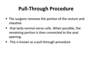 Hirschsprung's disease | PPTX