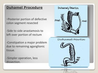 Hirschsprung's disease by dr abhinav kesarwani | PPT