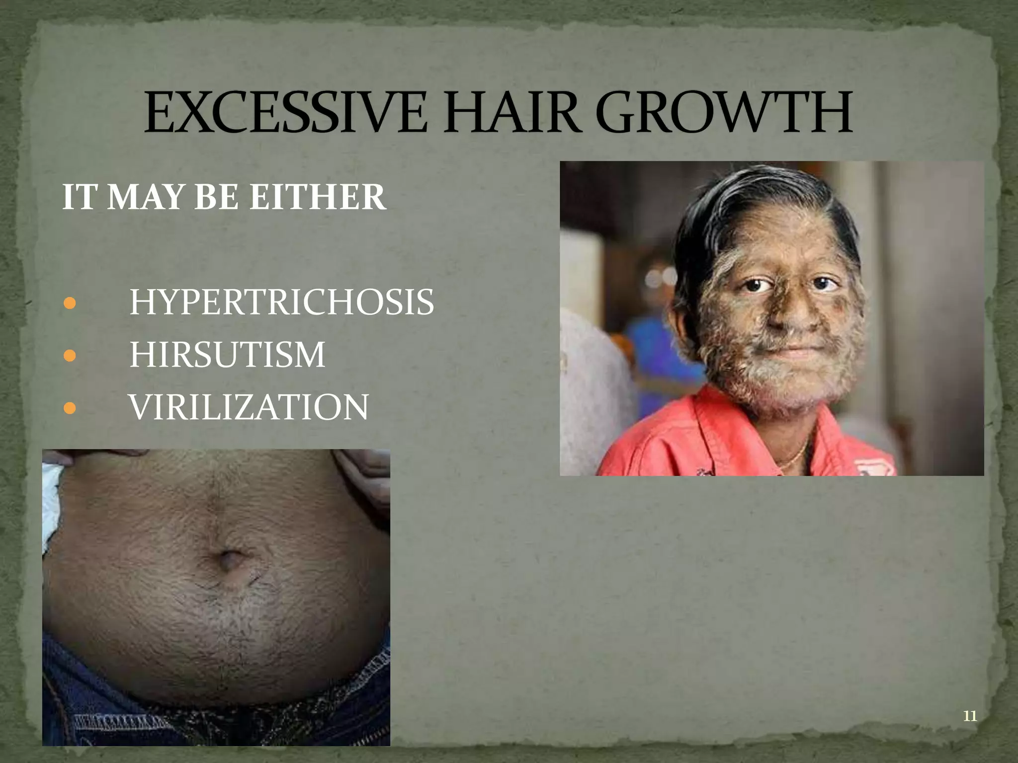 Hirsutism | PPTX