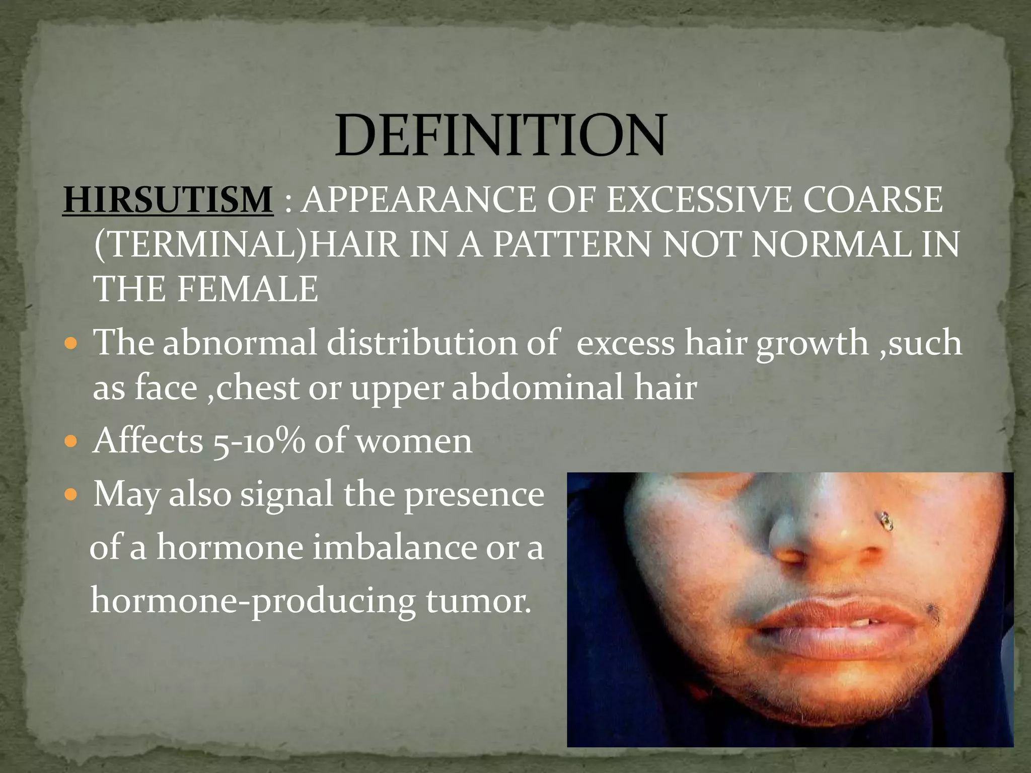 Hirsutism | PPTX