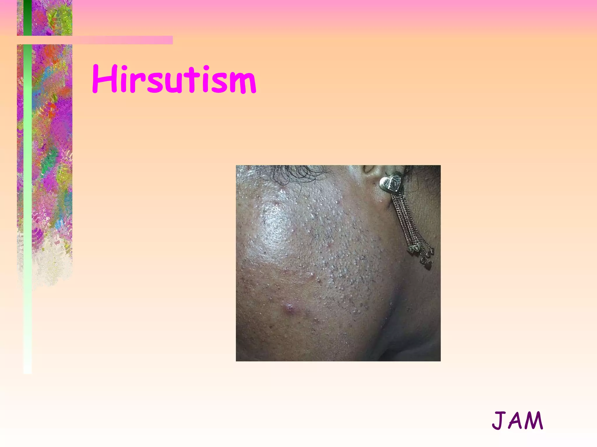 Hirsutism | PPT