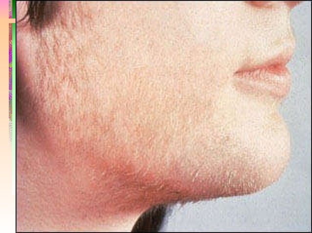 Hirsutism | PPT | Hormonal Disorders | Endocrine and Metabolic Diseases