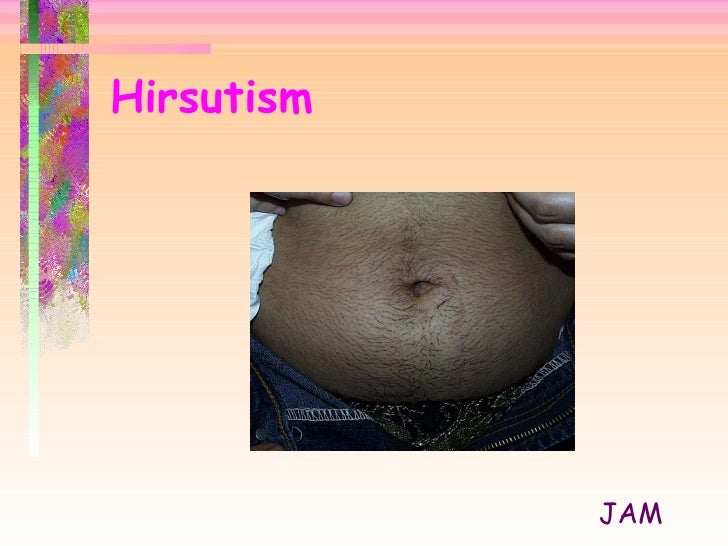 Hirsutism