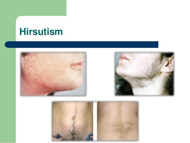 Hirsutism