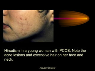 Pcos Hirsutism